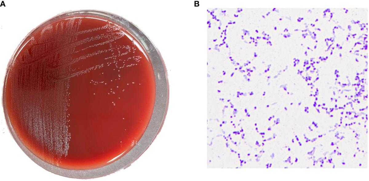 Frontiers | A rare bacteremia caused by Fannyhessea vaginae in a ...
