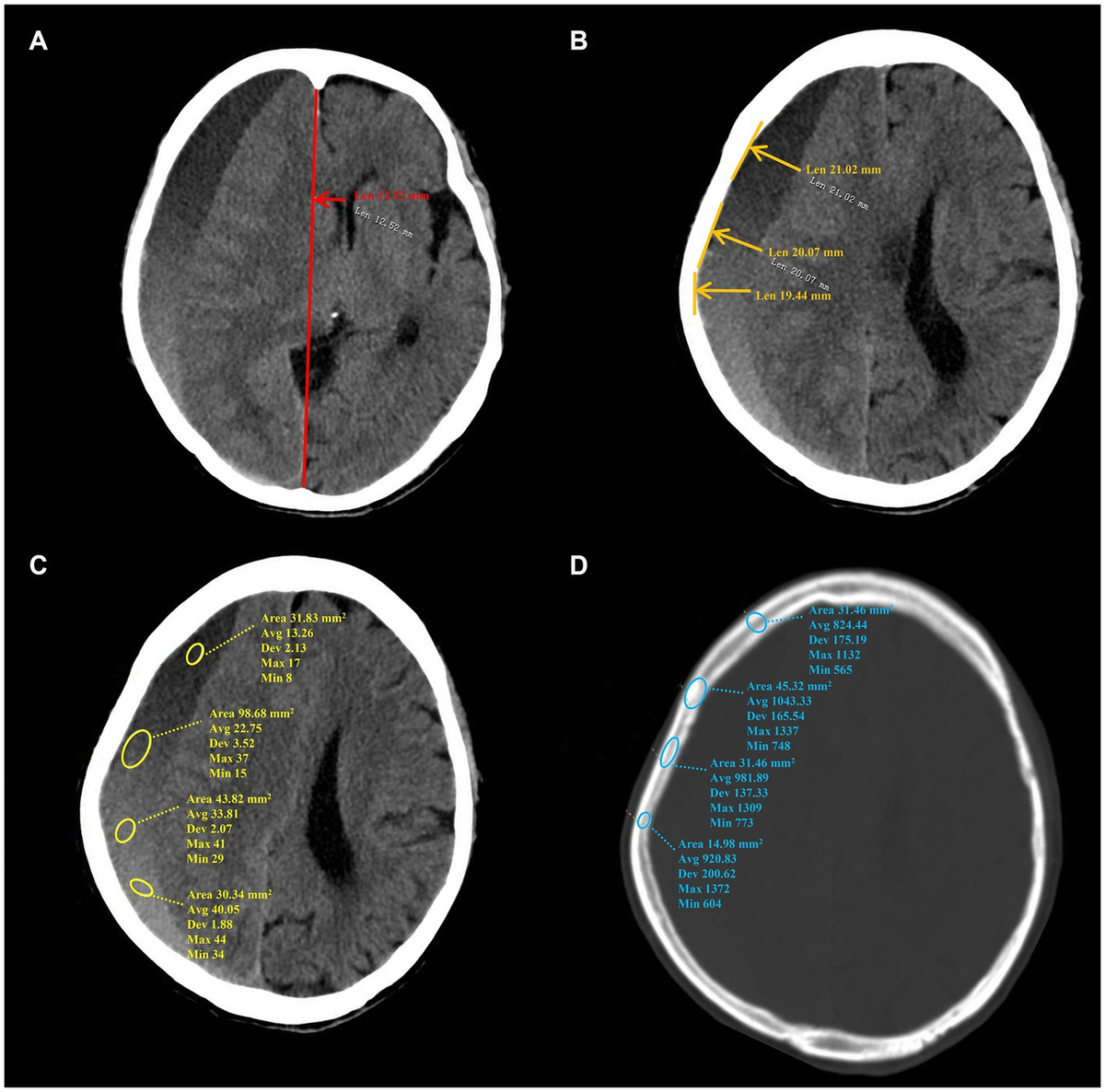 Frontiers | Predicting the progression of chronic subdural hematoma ...