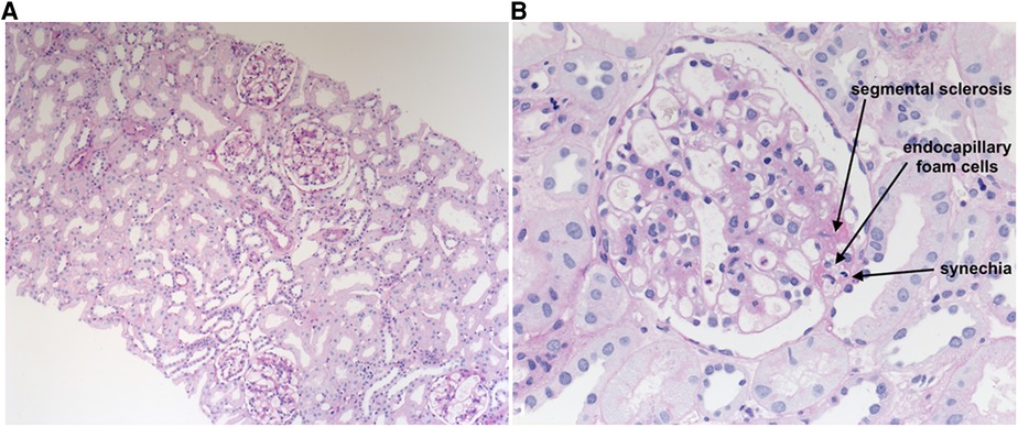 Frontiers | Case report: Early onset de novo FSGS in a child after ...