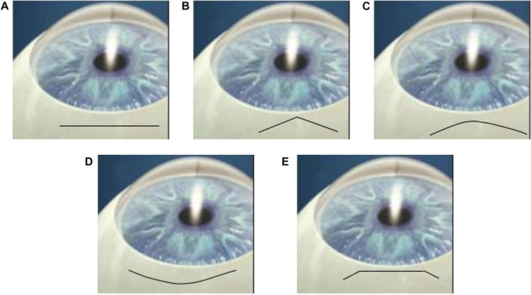 Frontiers | Numerical study of critical straight, frown, and chevron ...