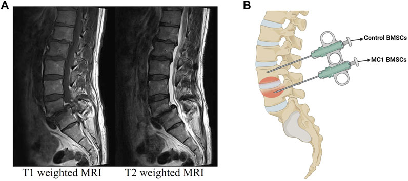 Frontiers | Bone marrow stromal cells in Modic type 1 changes promote ...