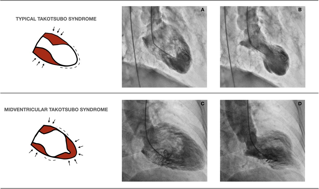 Frontiers | Comparative electrocardiographic analysis of midventricular ...