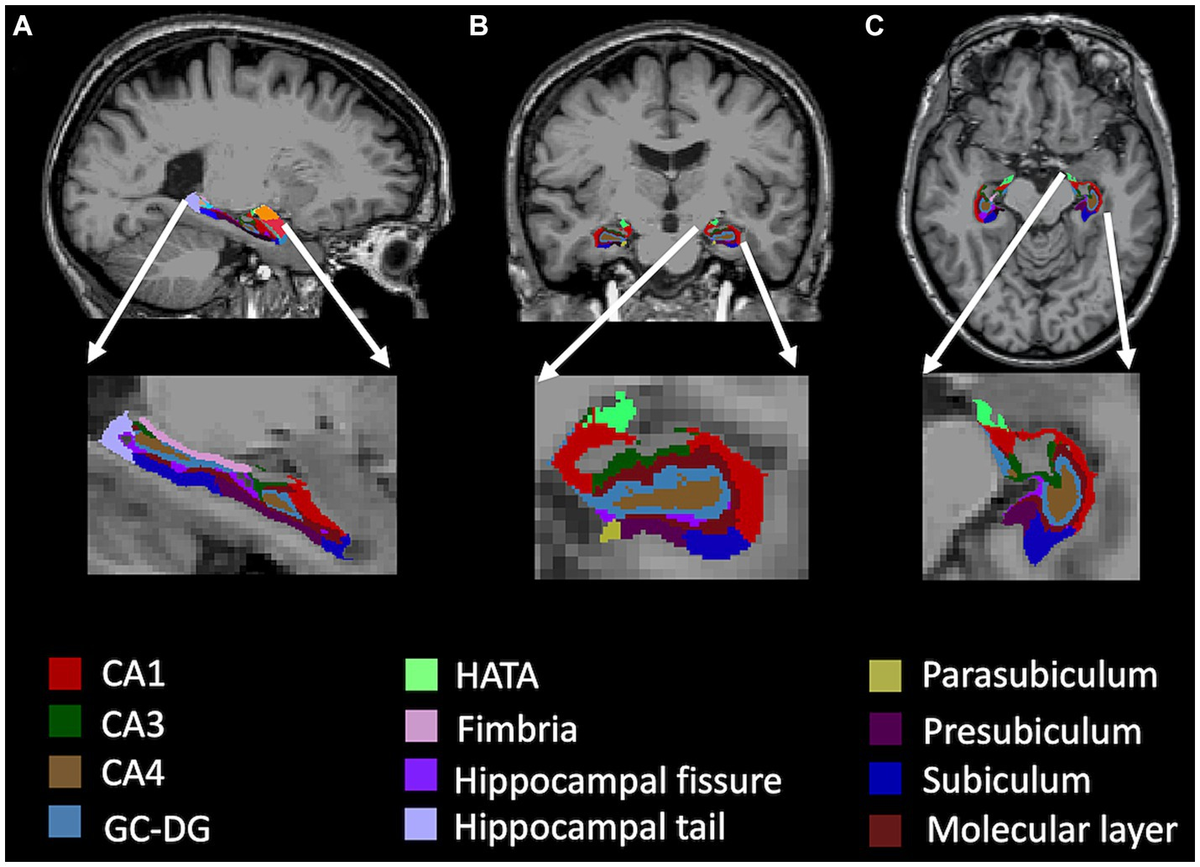 Frontiers | Atrophy of hippocampal subfields relates to memory decline ...