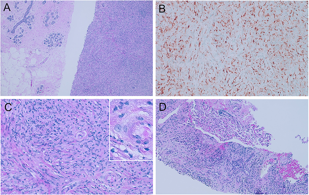 Frontiers Case Report Alk Positive Histiocytosis Presented As