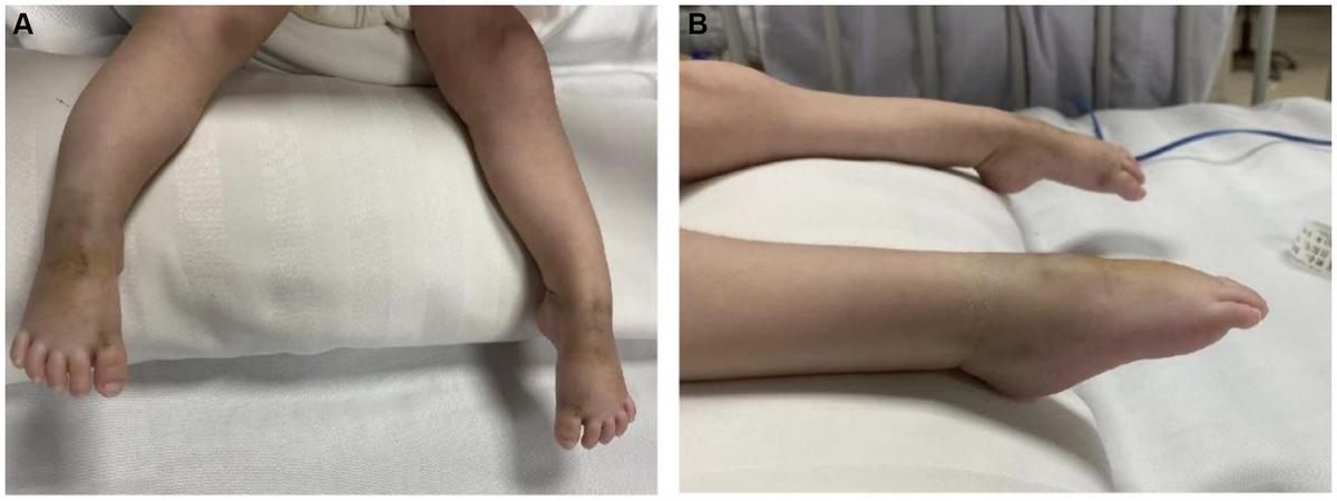 Frontiers | Case report: Heterozygous variation in the IGHMBP2 gene ...