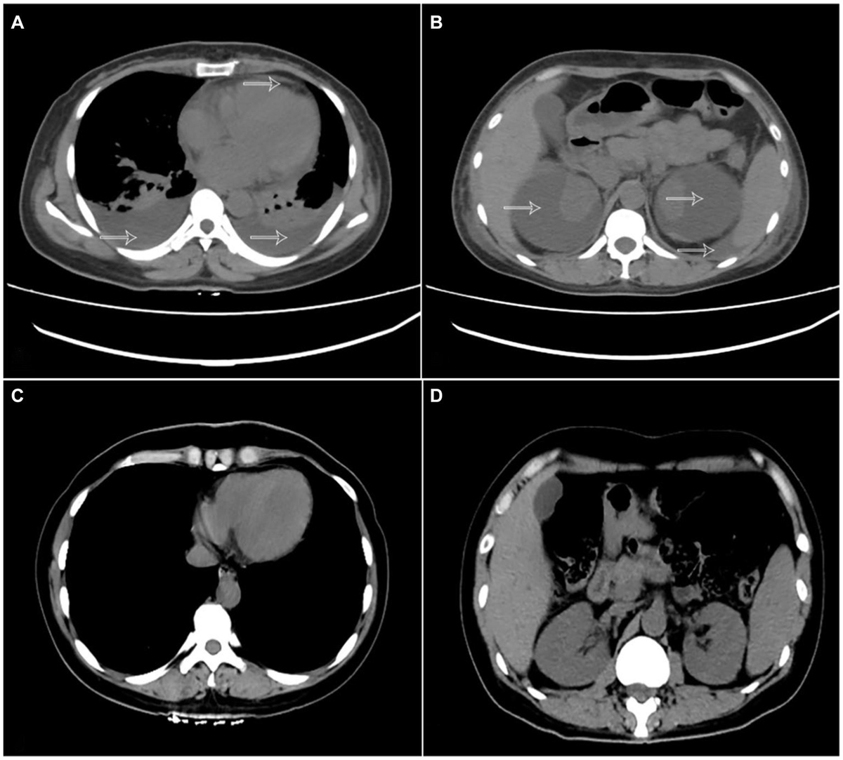 Frontiers | Case report: Page kidney with multiple serosal effusions ...