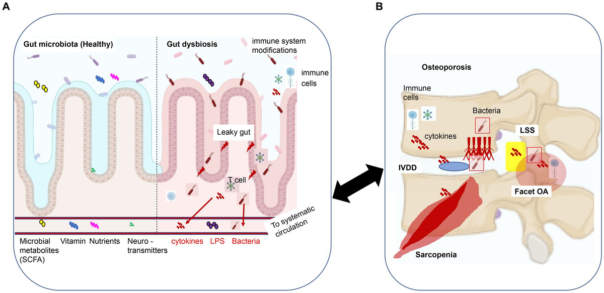 Frontiers | Gut-spine axis: a possible correlation between gut ...
