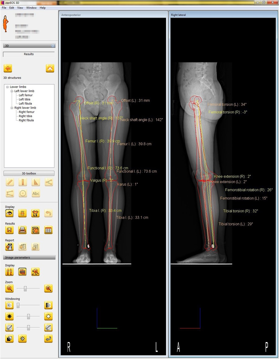 Frontiers | Analysis of lower extremity alignment (LEA) in children with recurrent patellar ...