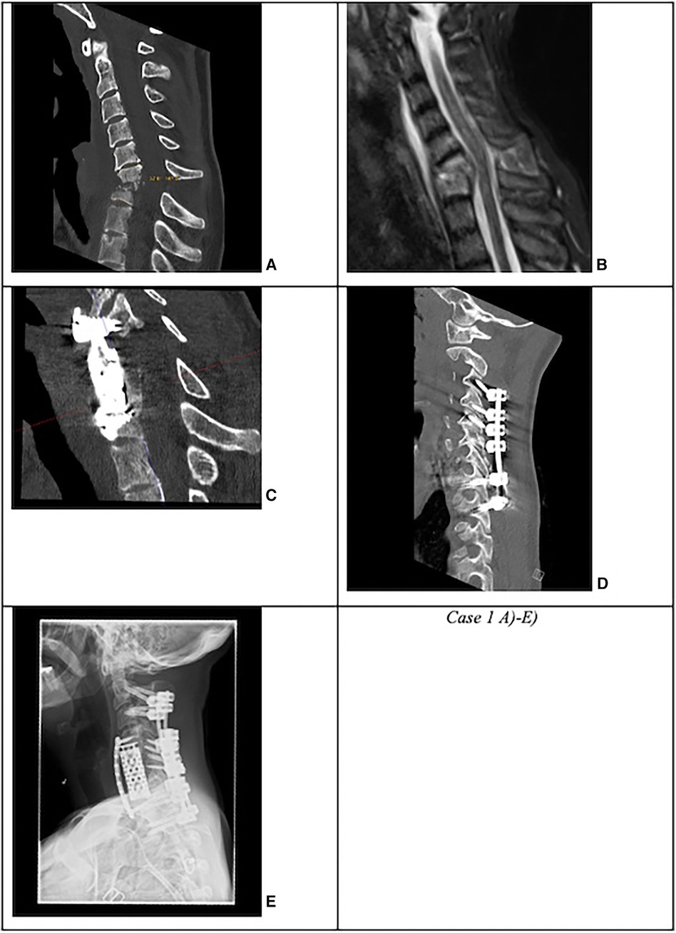 Frontiers | Clinical and surgical outcome in patients with cervical ...