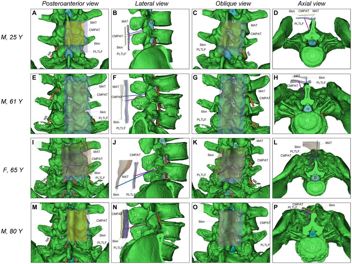 Frontiers | Computer-modified paramedian approach technique reduces ...