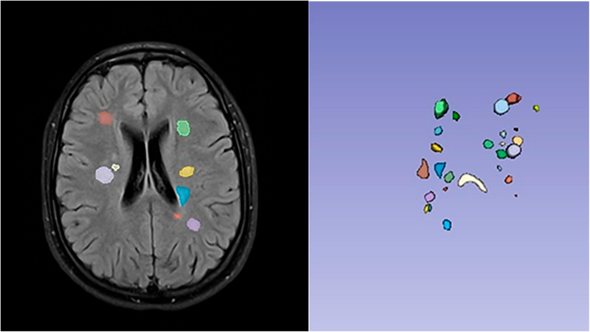 Frontiers | Neuroimaging characterization of multiple sclerosis lesions ...