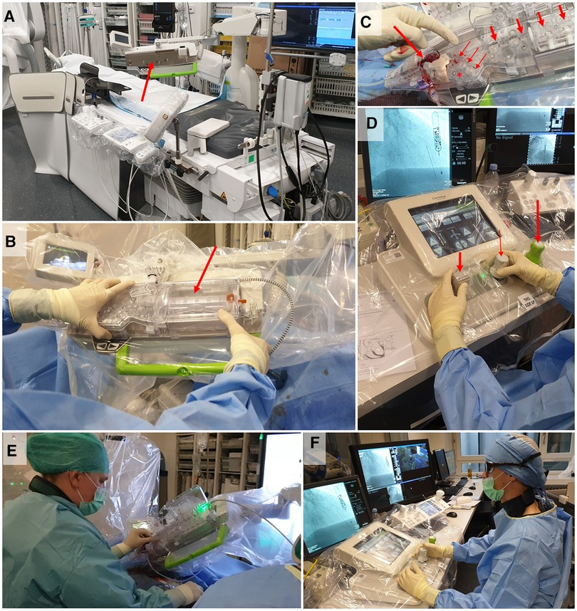 Frontiers | Robotic-assisted percutaneous coronary intervention ...
