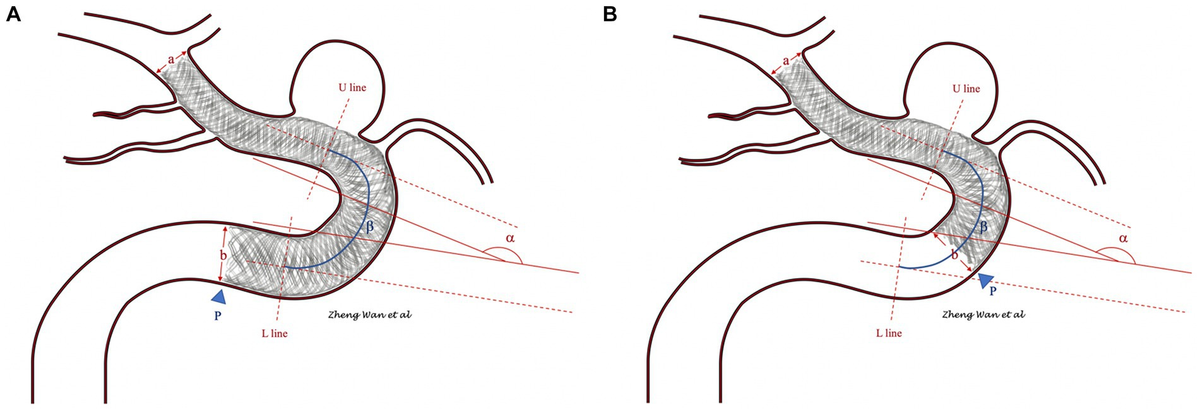 Frontiers | Flow diverter tail malapposition after implantation in the ...