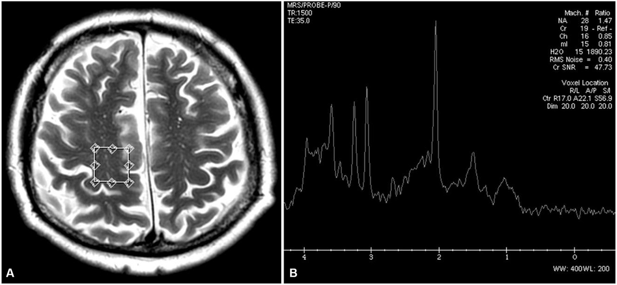 Frontiers | Central nervous system involvement in chronic inflammatory demyelinating ...