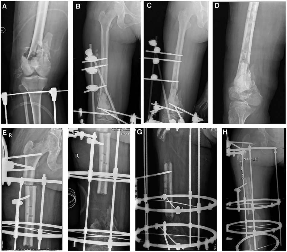 Frontiers | Bone transport combined with sequential nailing technique for the management of ...
