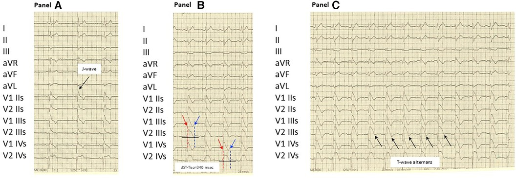 Frontiers | Non-invasive cardiac activation mapping and identification of severity of epicardial ...