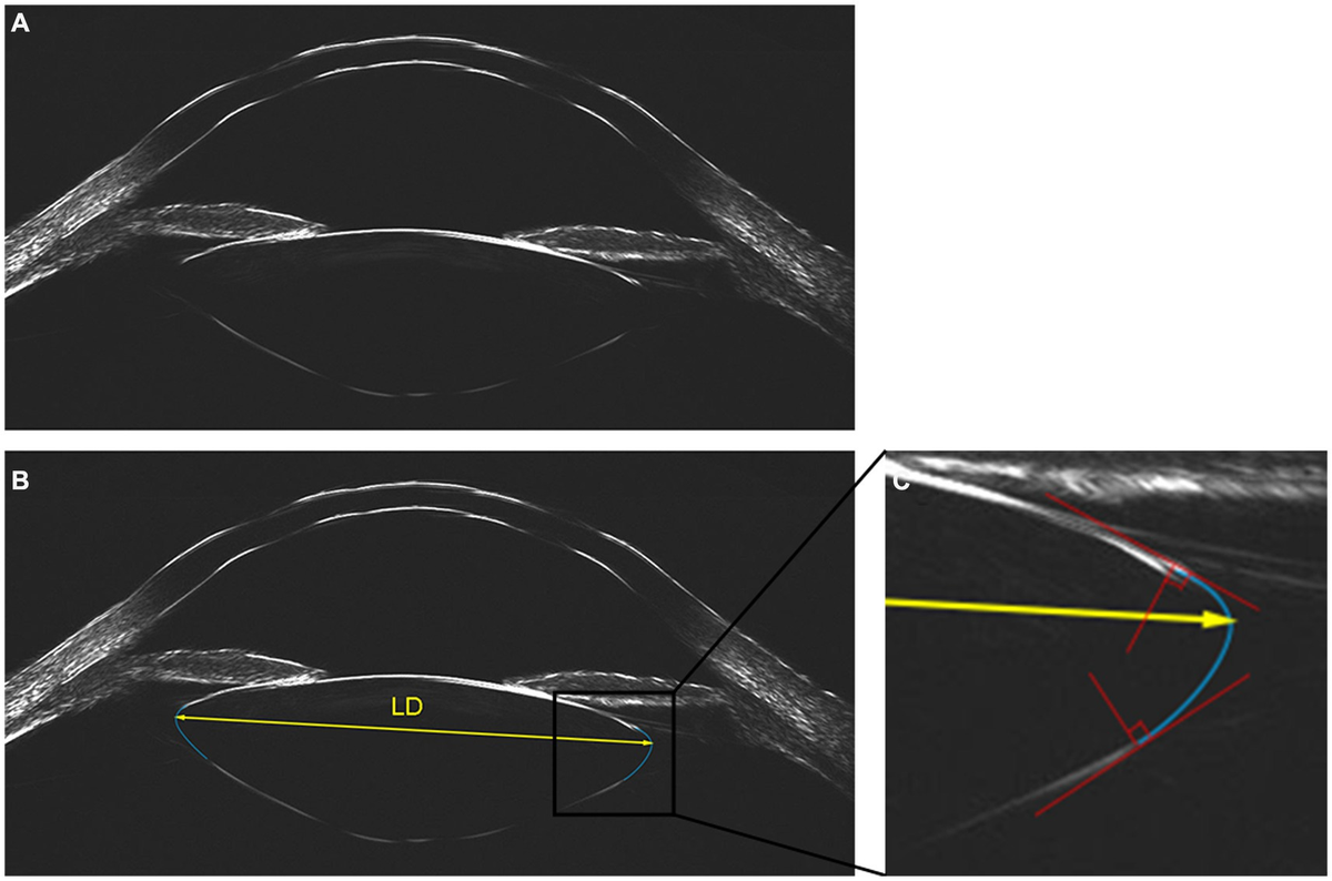 Frontiers | The relationships between lens diameter and ocular ...