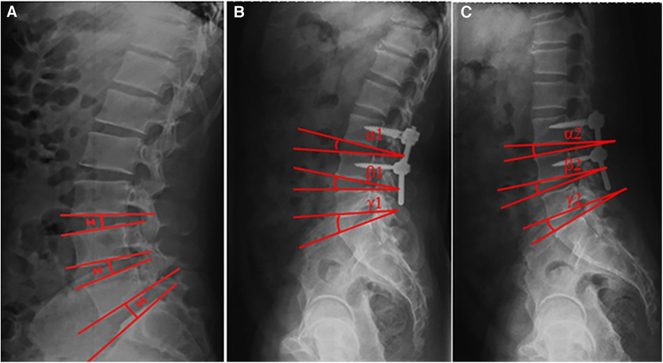 Frontiers | Using the pedicle screw-U rod system for the treatment of ...