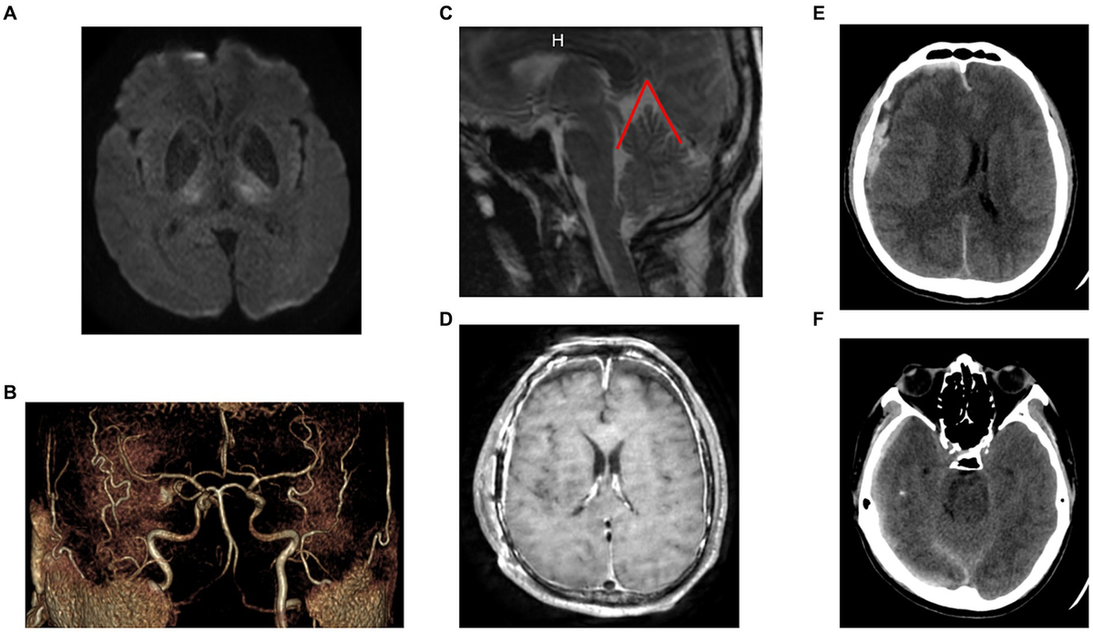 Frontiers | Case report: Simultaneous measurement of intracranial ...