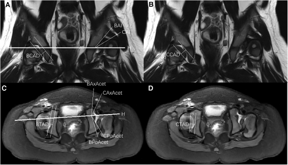 Frontiers | Analysis of the association between the acetabular ...