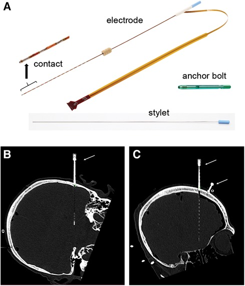 Frontiers | Implantation accuracy of novel polyimide stereotactic ...