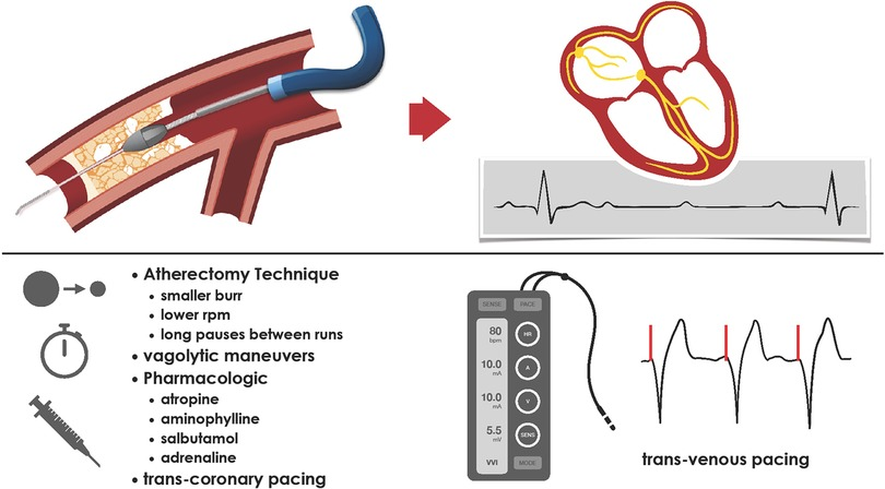 Frontiers | Emergency transvenous temporary pacing during rotational ...