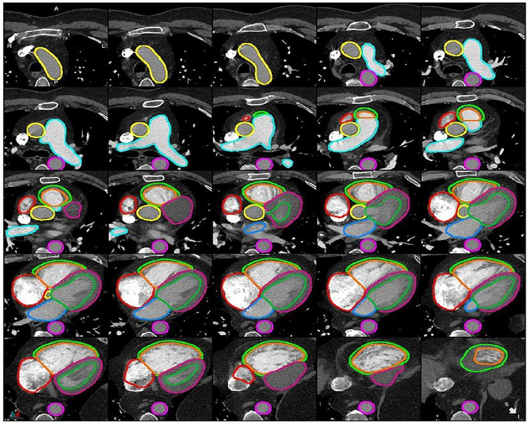 Frontiers | Advancements in cardiac structures segmentation: a comprehensive systematic review ...