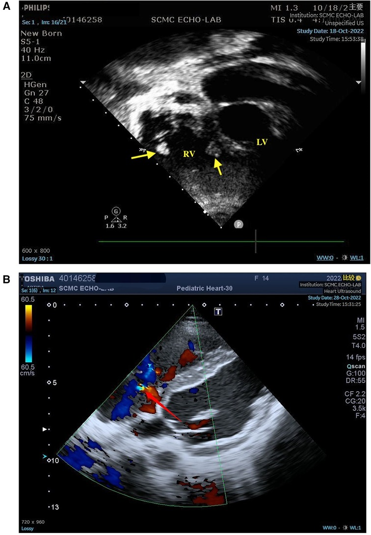 Frontiers | Libman-Sacks endocarditis in a child with systemic lupus ...