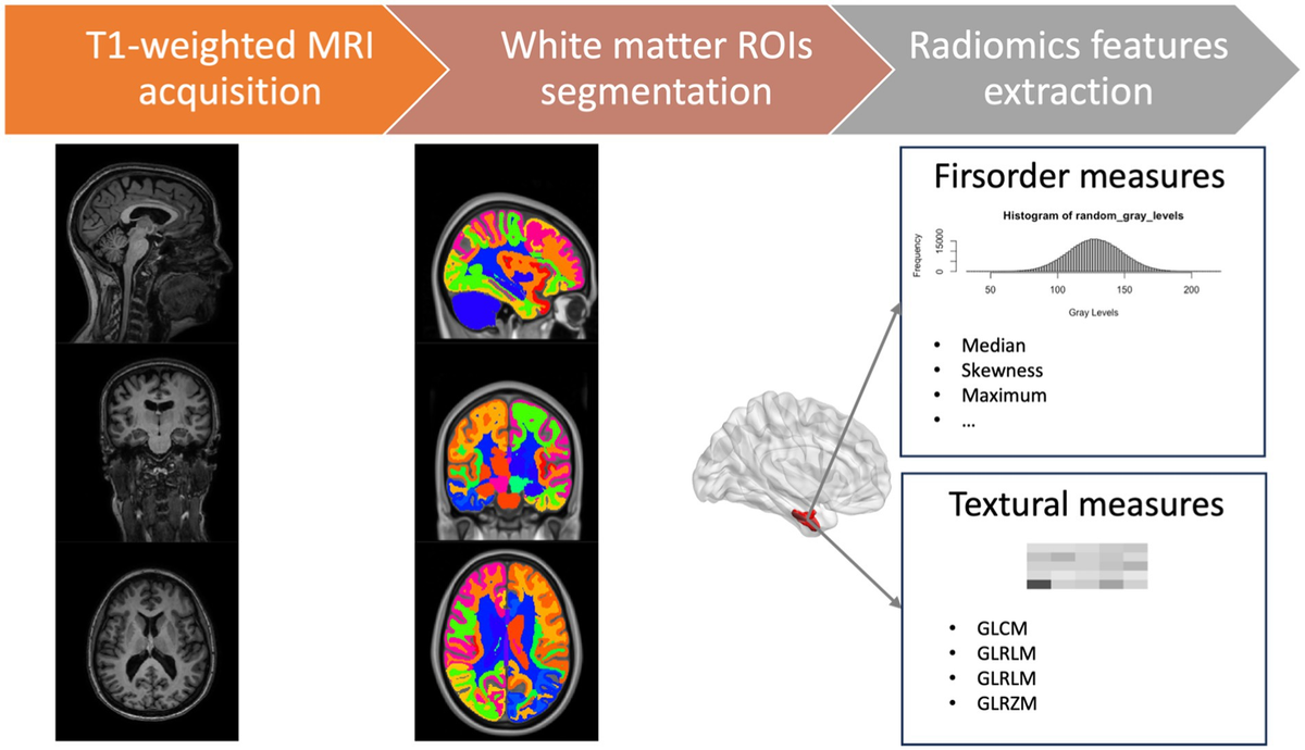 Frontiers | Explainable machine learning radiomics model for Primary ...