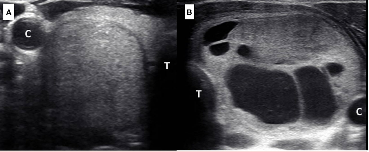 Frontiers | Improved cancer risk stratification of isoechoic thyroid ...