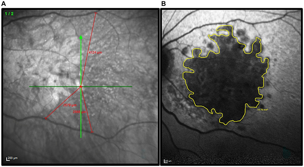 Frontiers | tRNS boosts visual perceptual learning in participants with ...