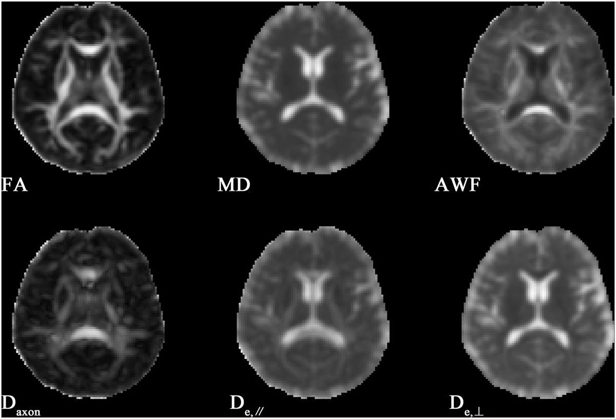 Frontiers | Analysis of white matter tract integrity using diffusion kurtosis imaging reveals ...