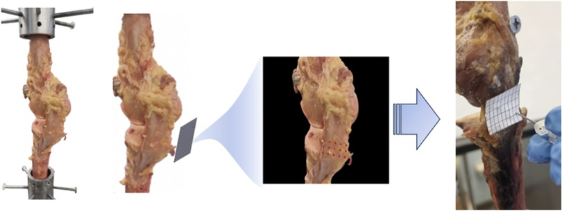 Frontiers | Precision soft tissue balancing: grid-assisted pie-crusting ...
