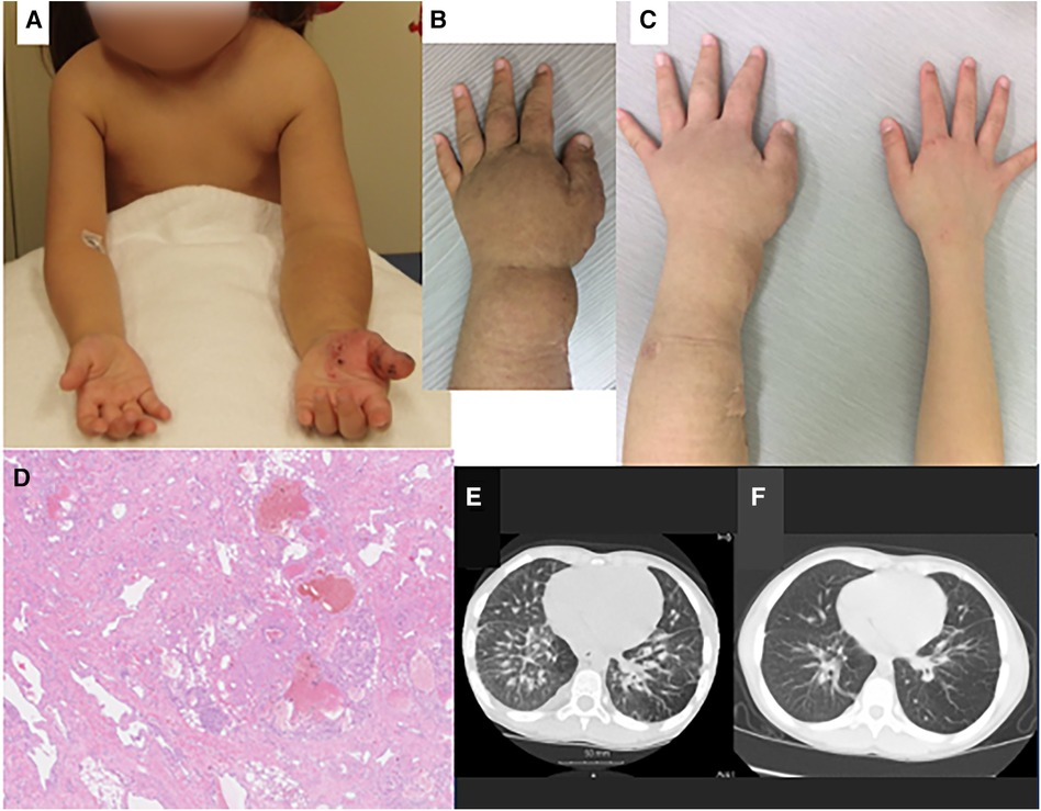 Frontiers | Case Report: Tuberous sclerosis complex-associated ...