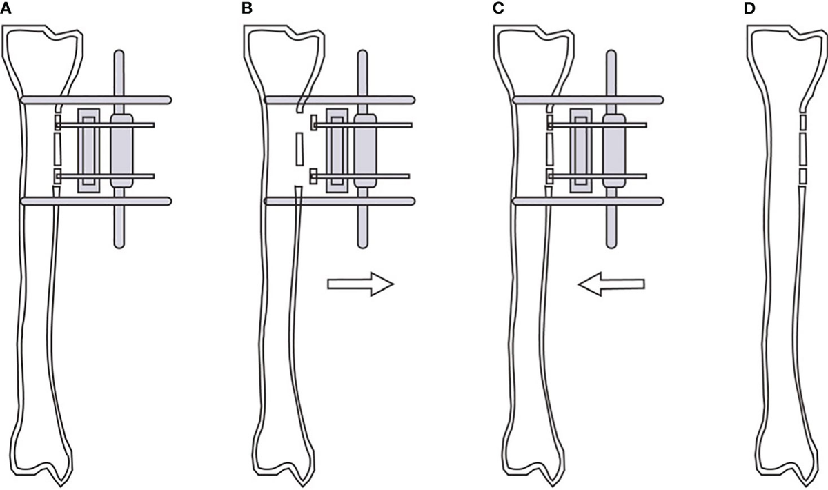 Frontiers | Modified tibial cortex transverse transport for diabetic ...