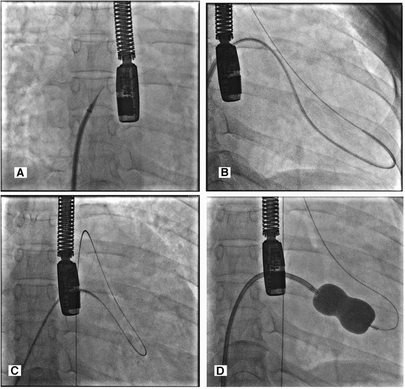 Frontiers | Revisiting percutaneous balloon mitral valvotomy technique ...