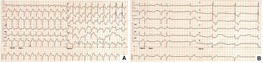 Frontiers | Case Report: Temporary pacing using active fixation lead ...