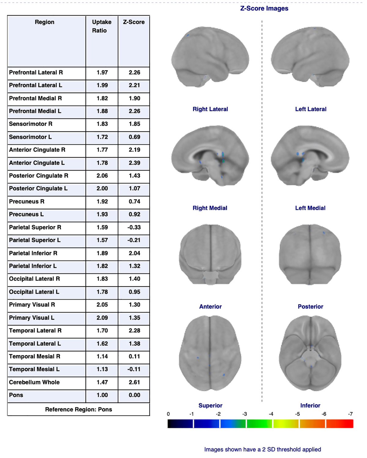 Frontiers | Posterior cingulate cortex hyperactivity in conversion ...