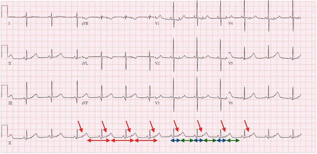 Frontiers | Case Report: Bradycardia in neonatal lupus: differential ...