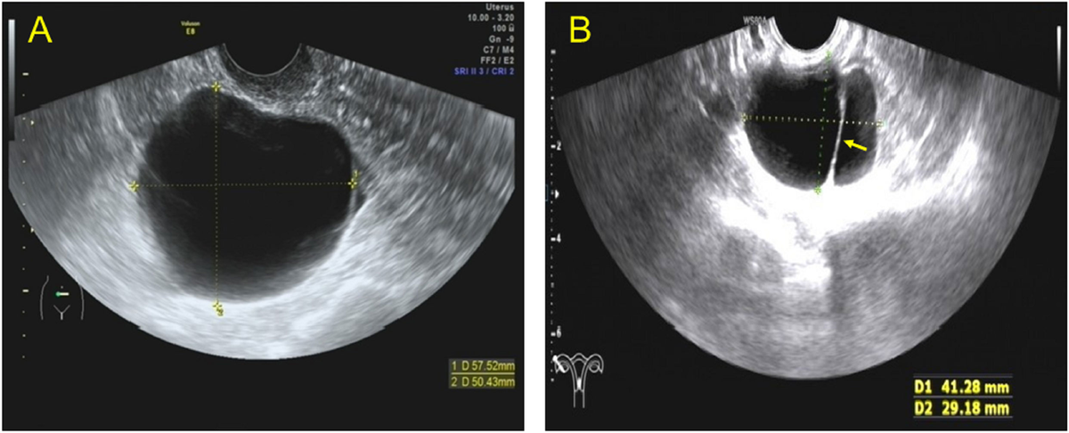 Frontiers Benign Brenner Tumor Of The Ovary Two Dimensional And