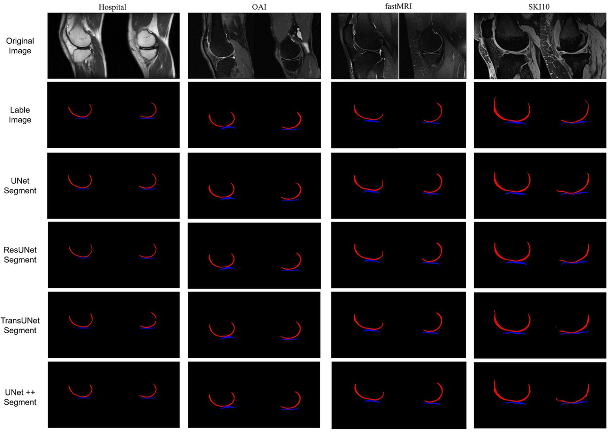 Frontiers | Automated measurement and grading of knee cartilage ...