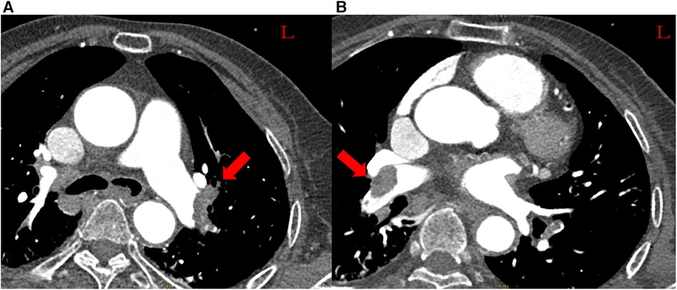 Frontiers | Case Report: Thrombus aspiration and in situ thrombolysis ...