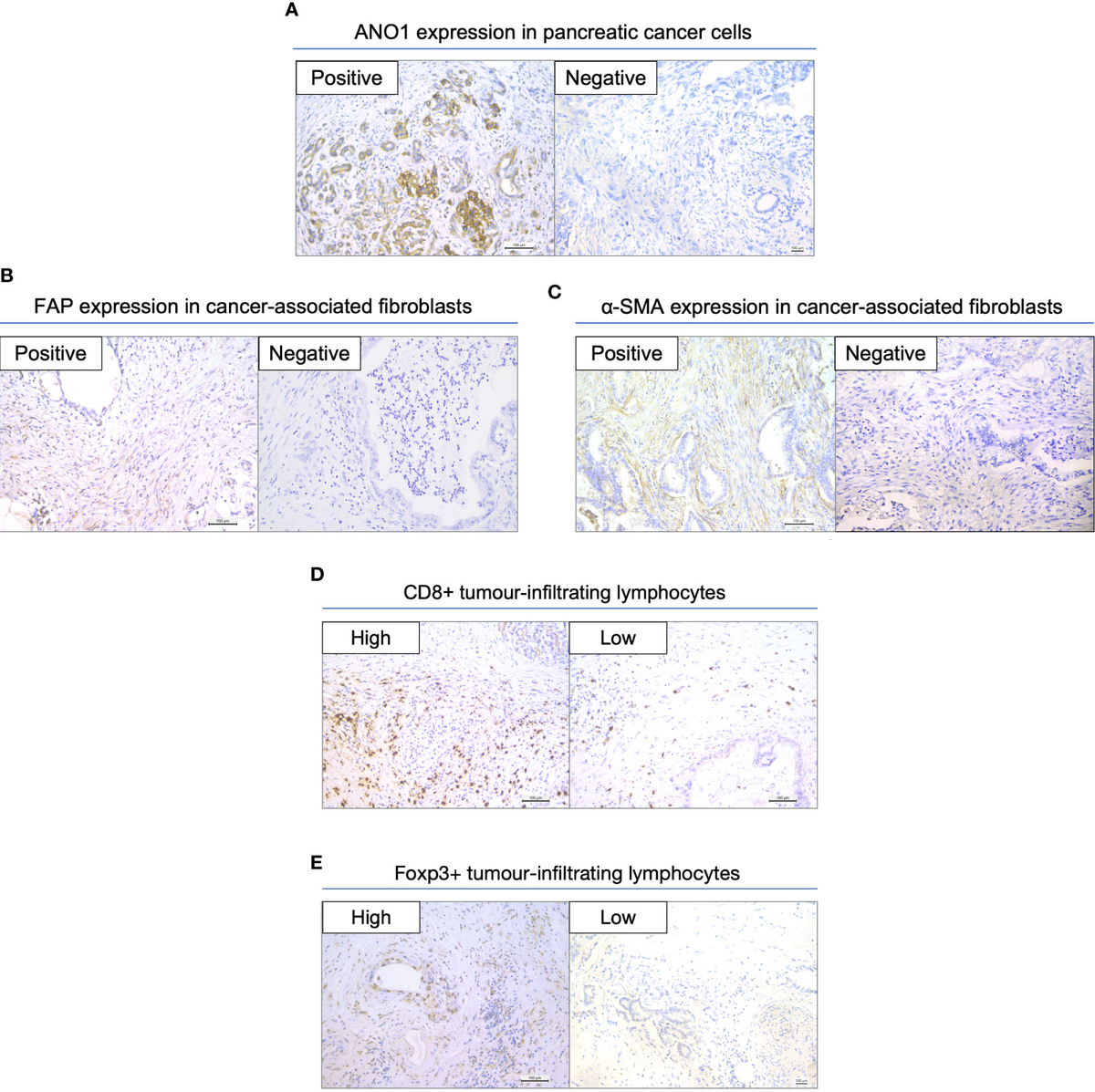 Frontiers | High ANO1 expression is a prognostic factor and correlated ...