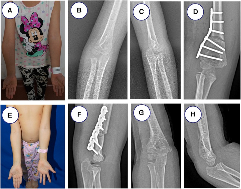 Frontiers | Locking plate versus K-wires and cast fixation in lateral ...