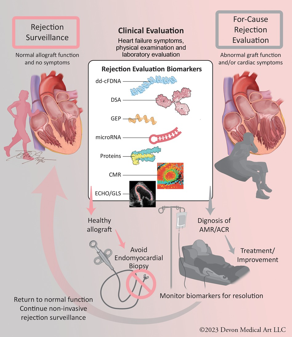Frontiers | A gentler approach to monitor for heart transplant rejection