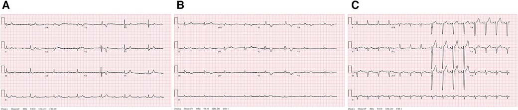 Frontiers | Case Report: Complete atrioventricular block in an elderly ...