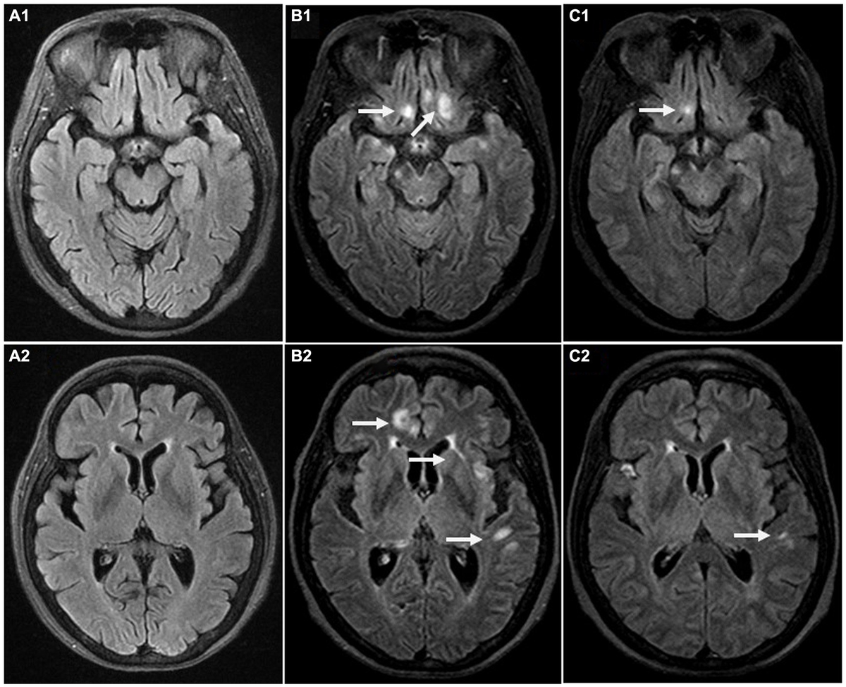 Frontiers | Case report: A case of anti-glycine receptor ...