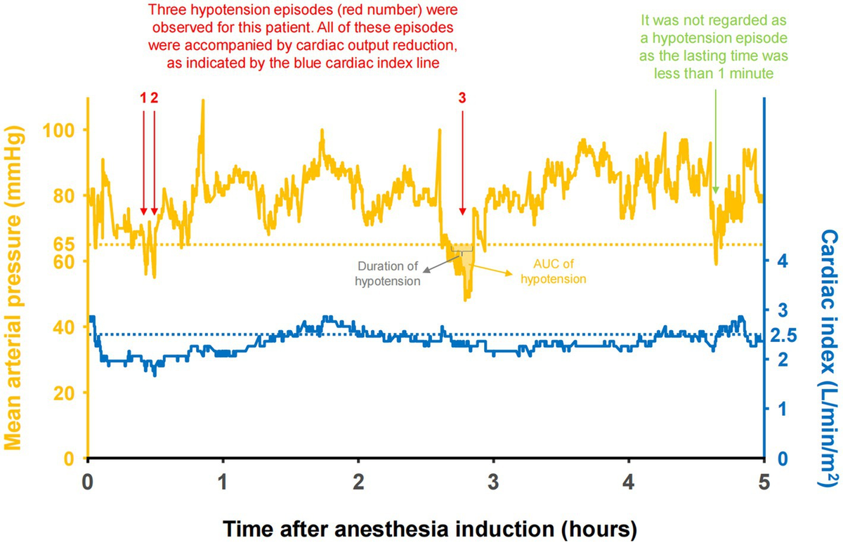 Frontiers | The exploration of perioperative hypotension subtypes: a ...