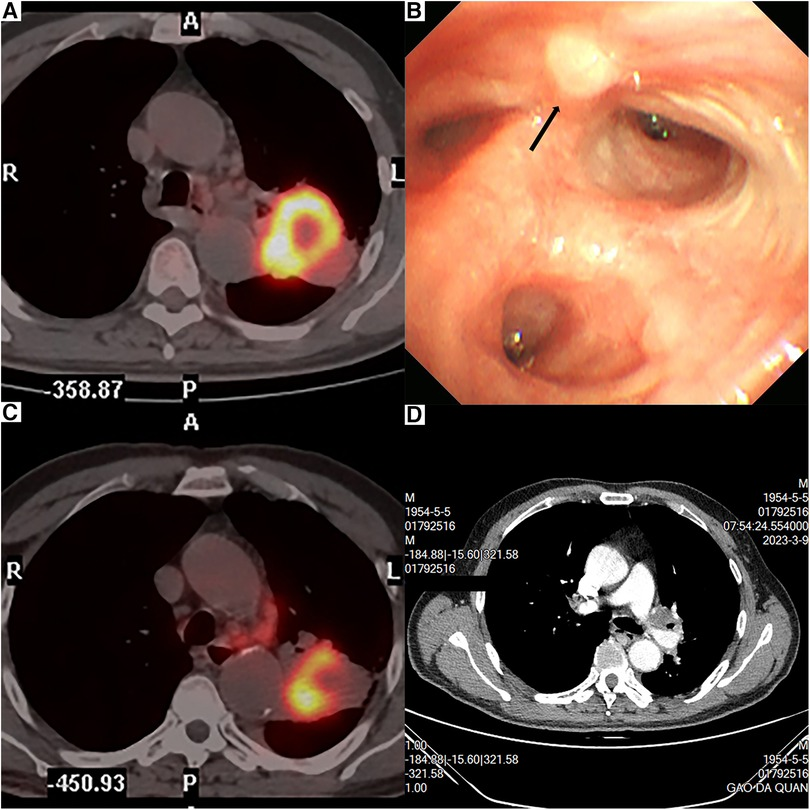 Frontiers | Case Report: Uniportal robot-assisted thoracoscopic double ...