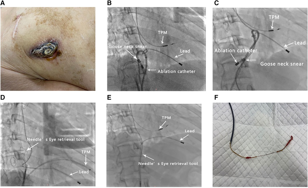 Frontiers | Case Report: Enhancing lead extraction techniques: a novel ...